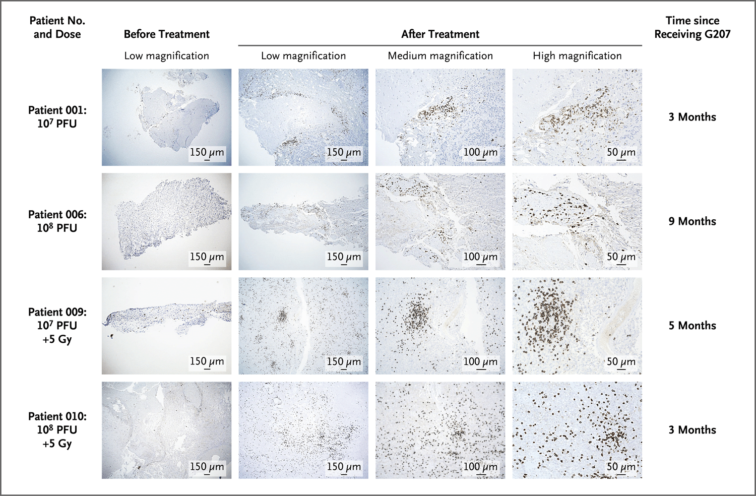 儿童高级别胶质瘤的溶瘤HSV-1 G207免疫病毒疗法 - NEJM医学前沿